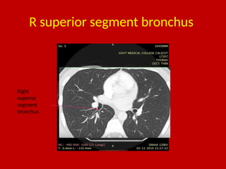 Basic interpretation of CT chest- identification of lobes and segments ...