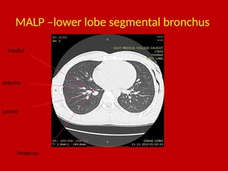 Basic interpretation of CT chest- identification of lobes and segments ...