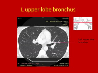 Basic interpretation of CT chest- identification of lobes and segments ...