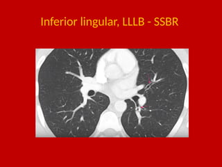 Basic interpretation of CT chest- identification of lobes and segments ...