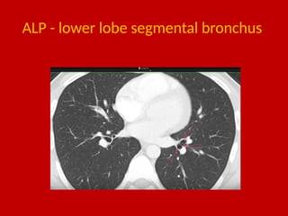 Basic interpretation of CT chest- identification of lobes and segments ...