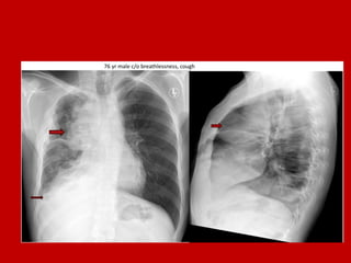 Basic interpretation of CT chest- identification of lobes and segments ...