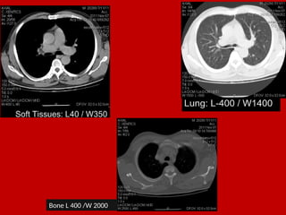 Basic interpretation of CT chest- identification of lobes and segments ...
