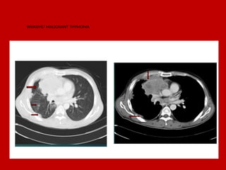 Basic interpretation of CT chest- identification of lobes and segments ...