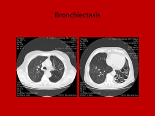 Basic interpretation of CT chest- identification of lobes and segments ...