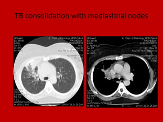 Basic interpretation of CT chest- identification of lobes and segments ...