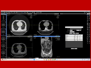 Basic interpretation of CT chest- identification of lobes and segments ...