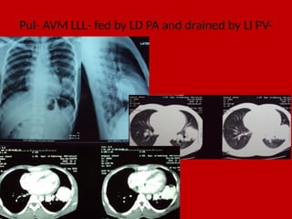 Basic interpretation of CT chest- identification of lobes and segments ...