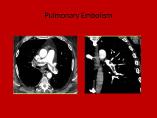 Basic interpretation of CT chest- identification of lobes and segments ...