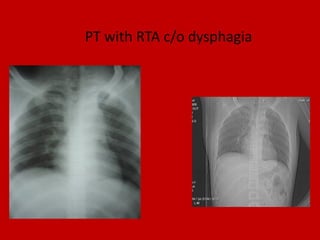 Basic interpretation of CT chest- identification of lobes and segments ...