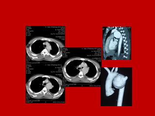 Basic interpretation of CT chest- identification of lobes and segments ...