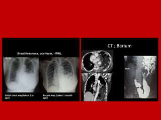 Basic interpretation of CT chest- identification of lobes and segments ...