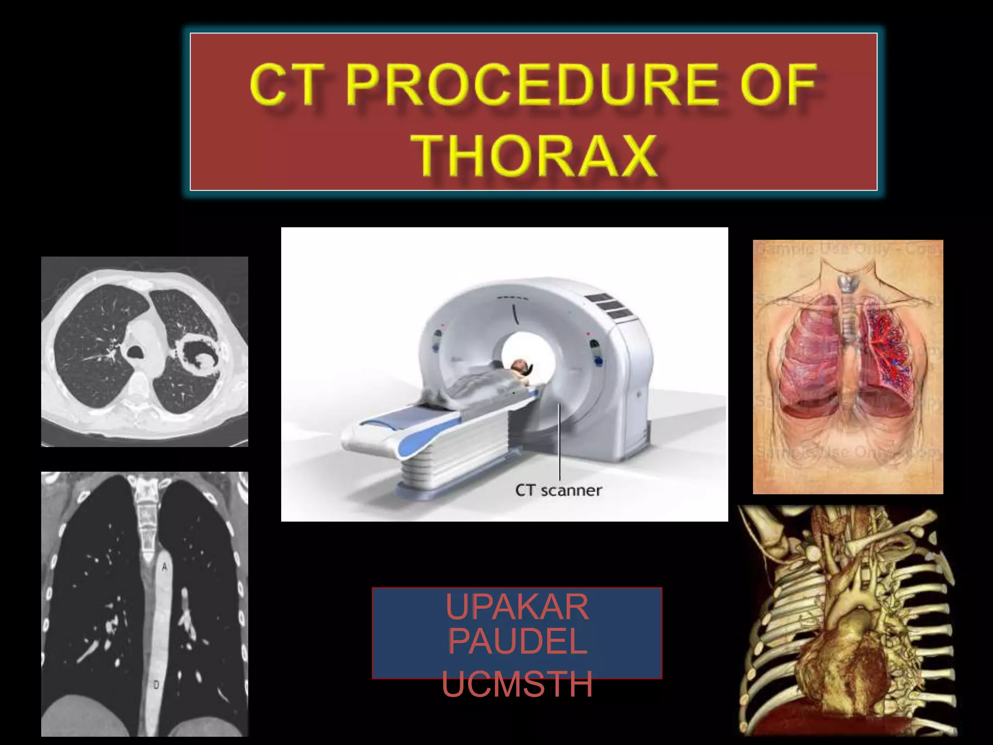 CT Procedure of Thorax (CT Chest) | PPTX