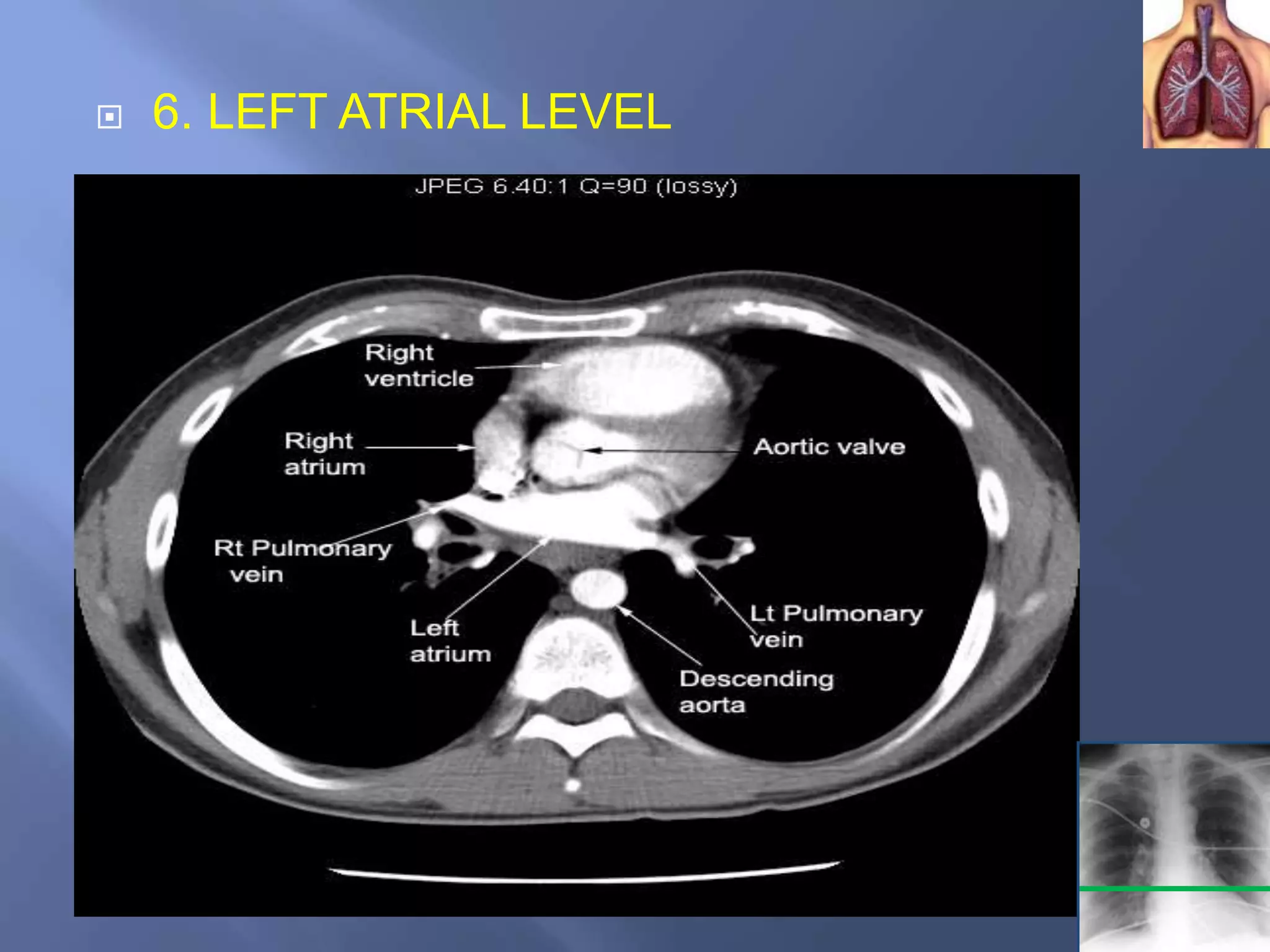 CT Procedure of Thorax (CT Chest) | PPTX