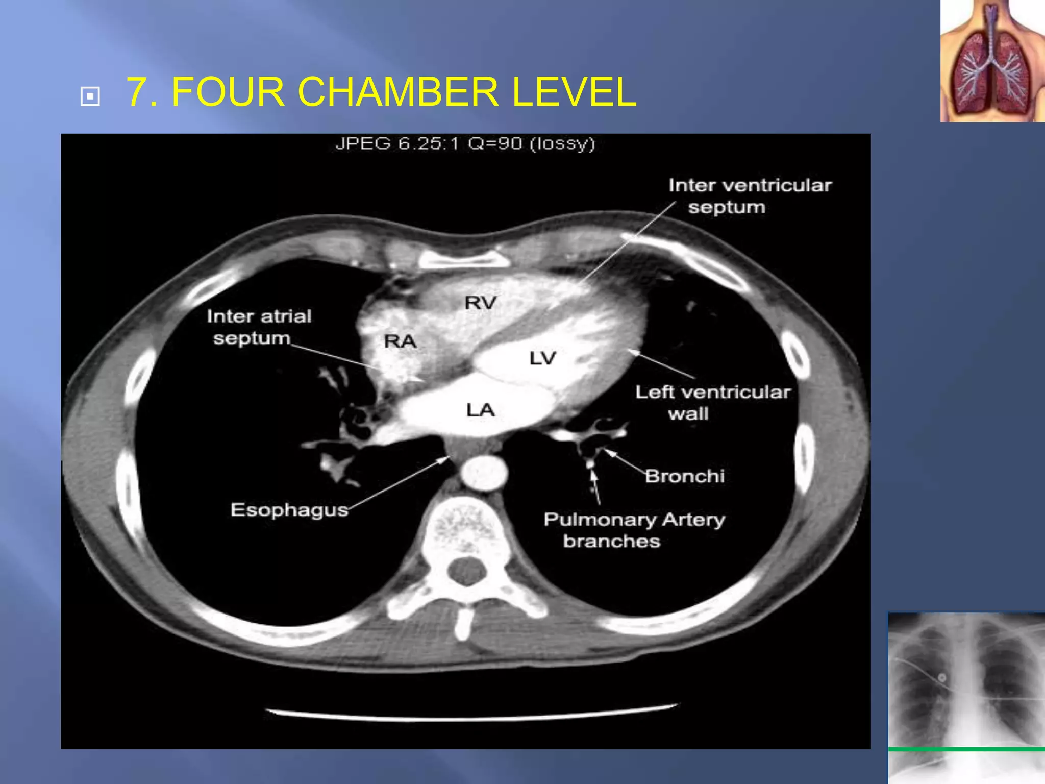 CT Procedure of Thorax (CT Chest) | PPTX