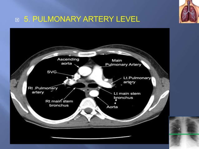 CT Procedure of Thorax (CT Chest) | PPTX