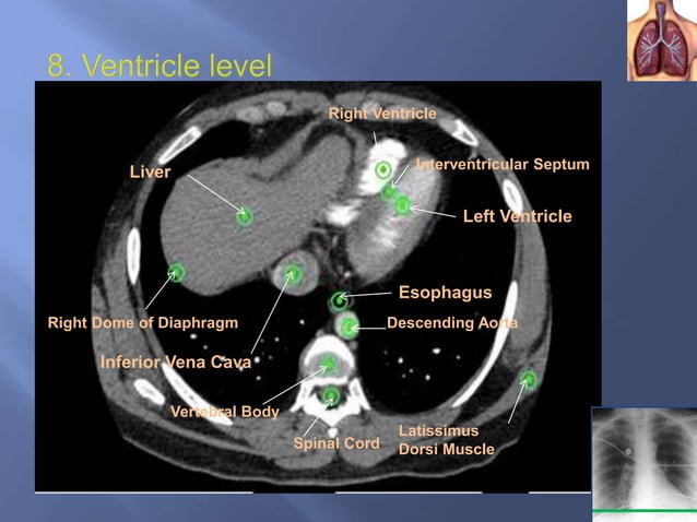 CT Procedure of Thorax (CT Chest) | PPTX
