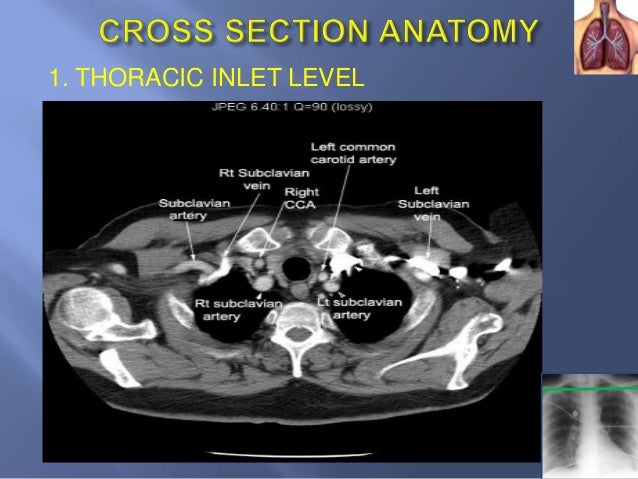 CT Procedure of Thorax (CT Chest)
