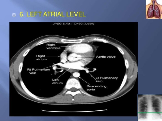 CT Procedure of Thorax (CT Chest)