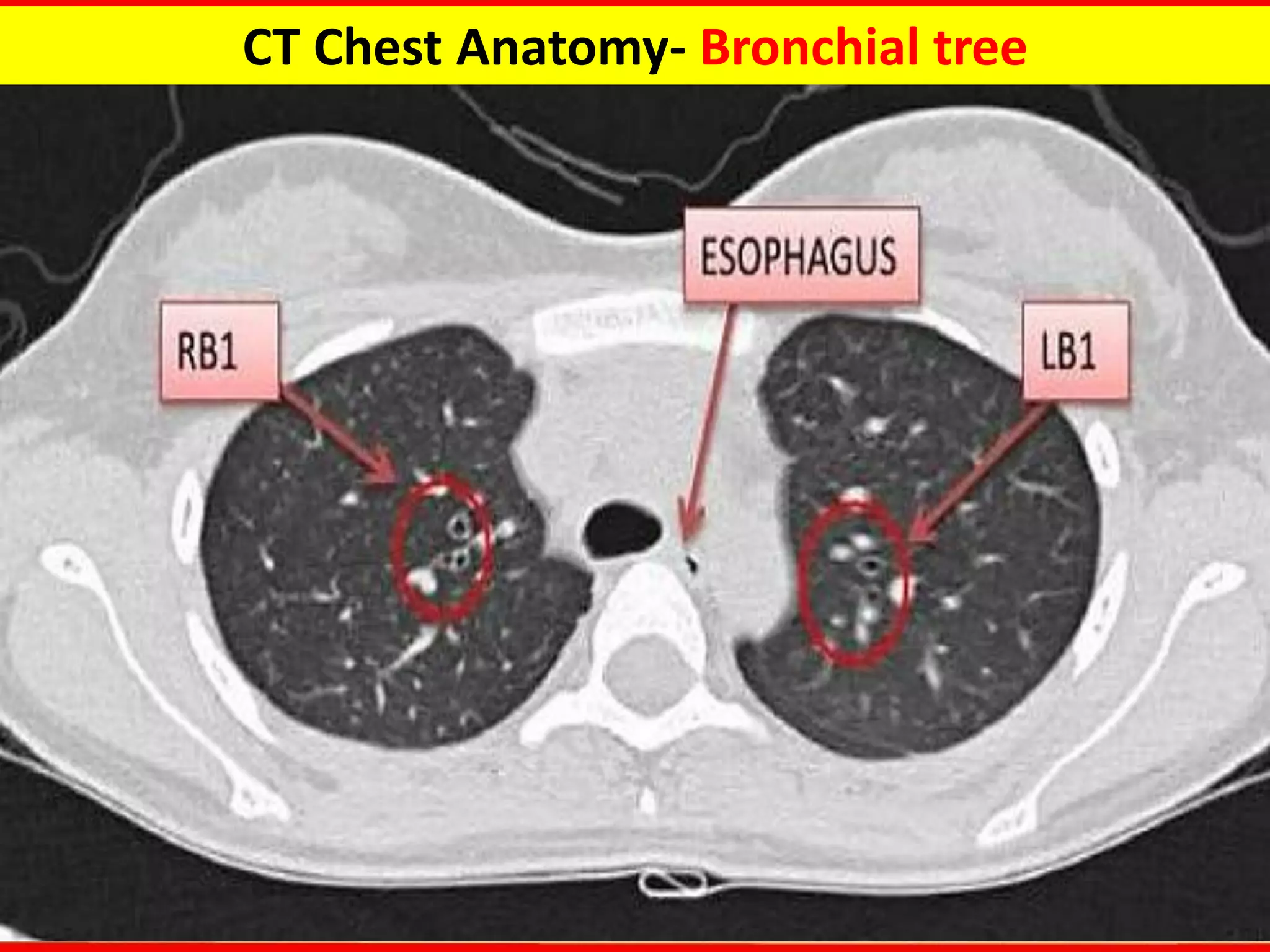 Ct chest fundamentals | PDF