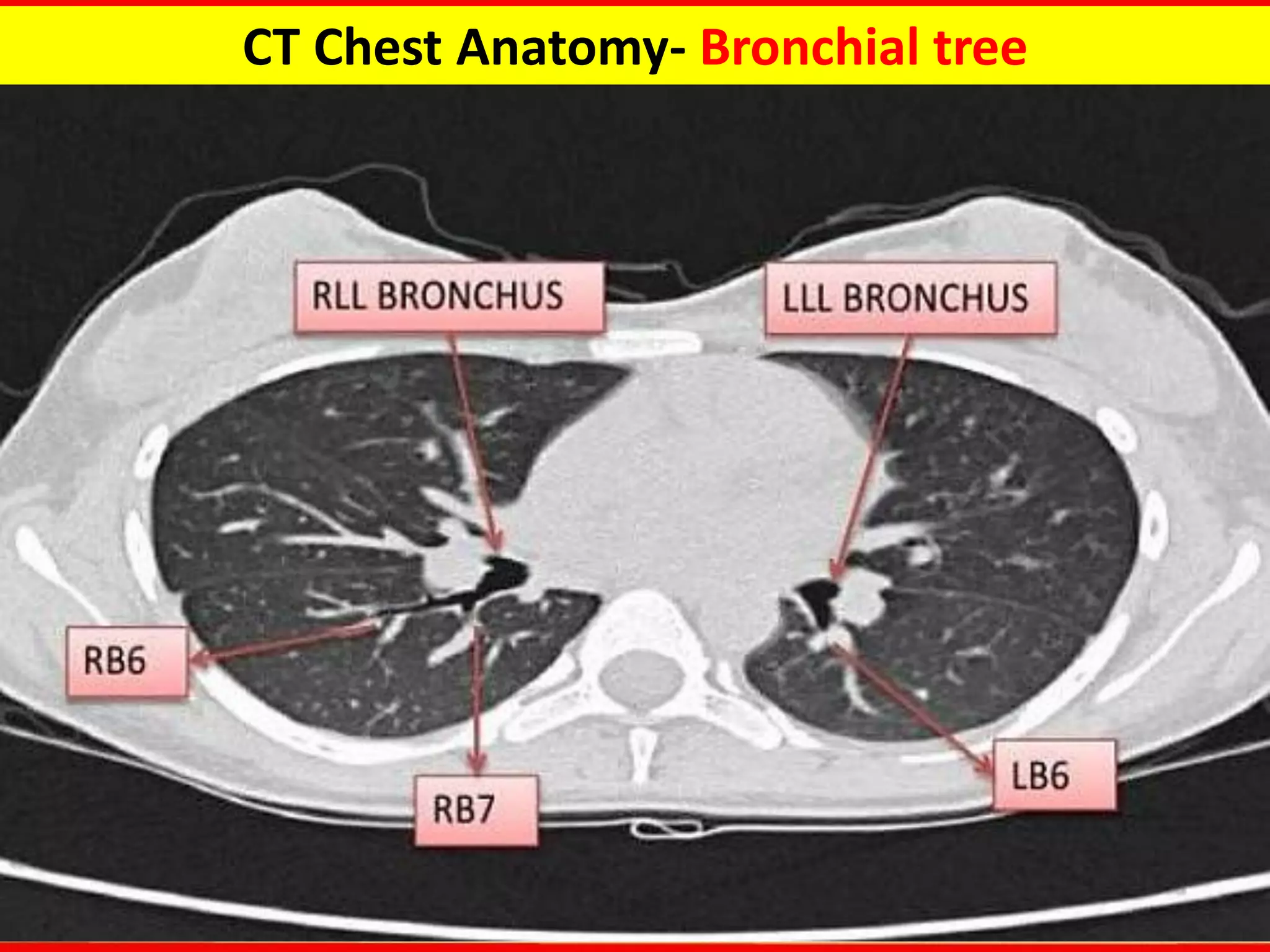 Ct chest fundamentals | PDF