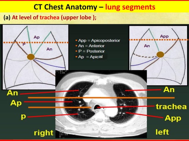 Ct chest fundamentals | PDF