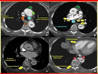 Ct chest fundamentals | PDF