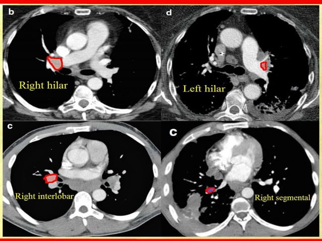 Ct chest fundamentals | PDF