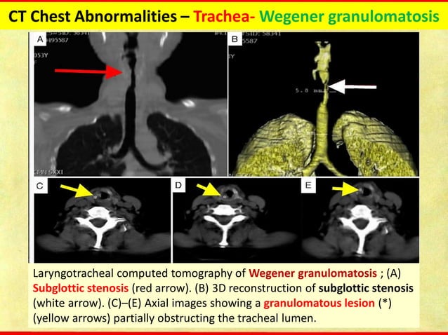 Ct chest fundamentals | PDF