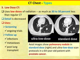 Ct chest fundamentals | PDF