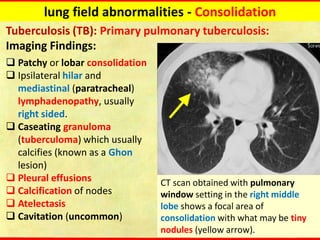 Ct chest fundamentals | PDF