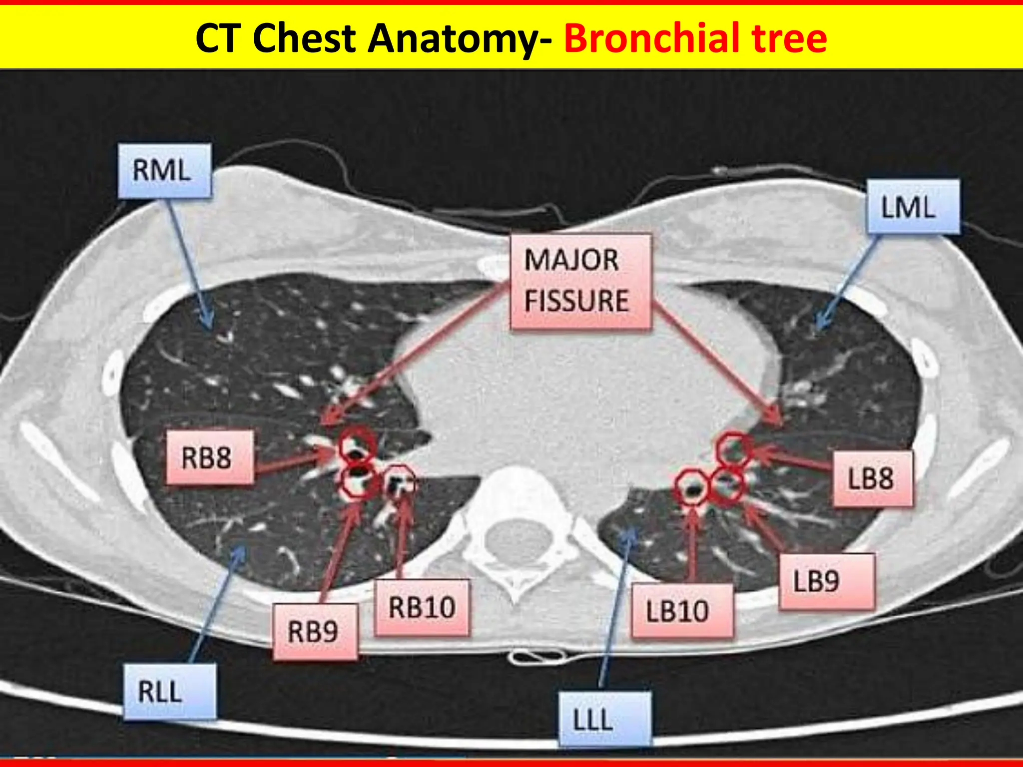 Computed tomography Chest Fundamentals update | PPT