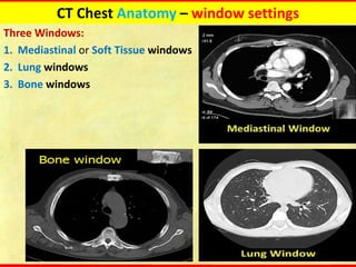 Computed tomography Chest Fundamentals update | PDF