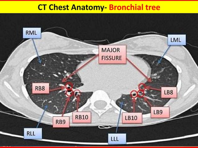 Computed tomography Chest Fundamentals update | PPT