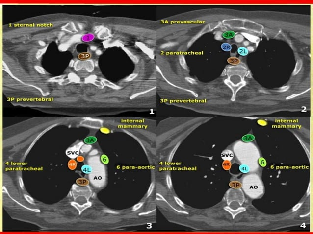 Computed tomography Chest Fundamentals update | PPT