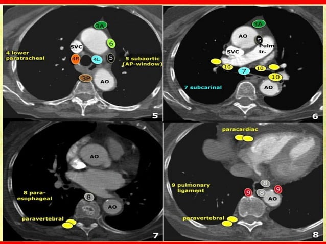 Computed tomography Chest Fundamentals update | PPT