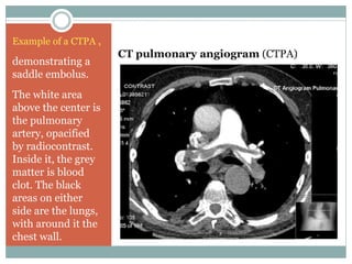 Ct chest type | PPTX