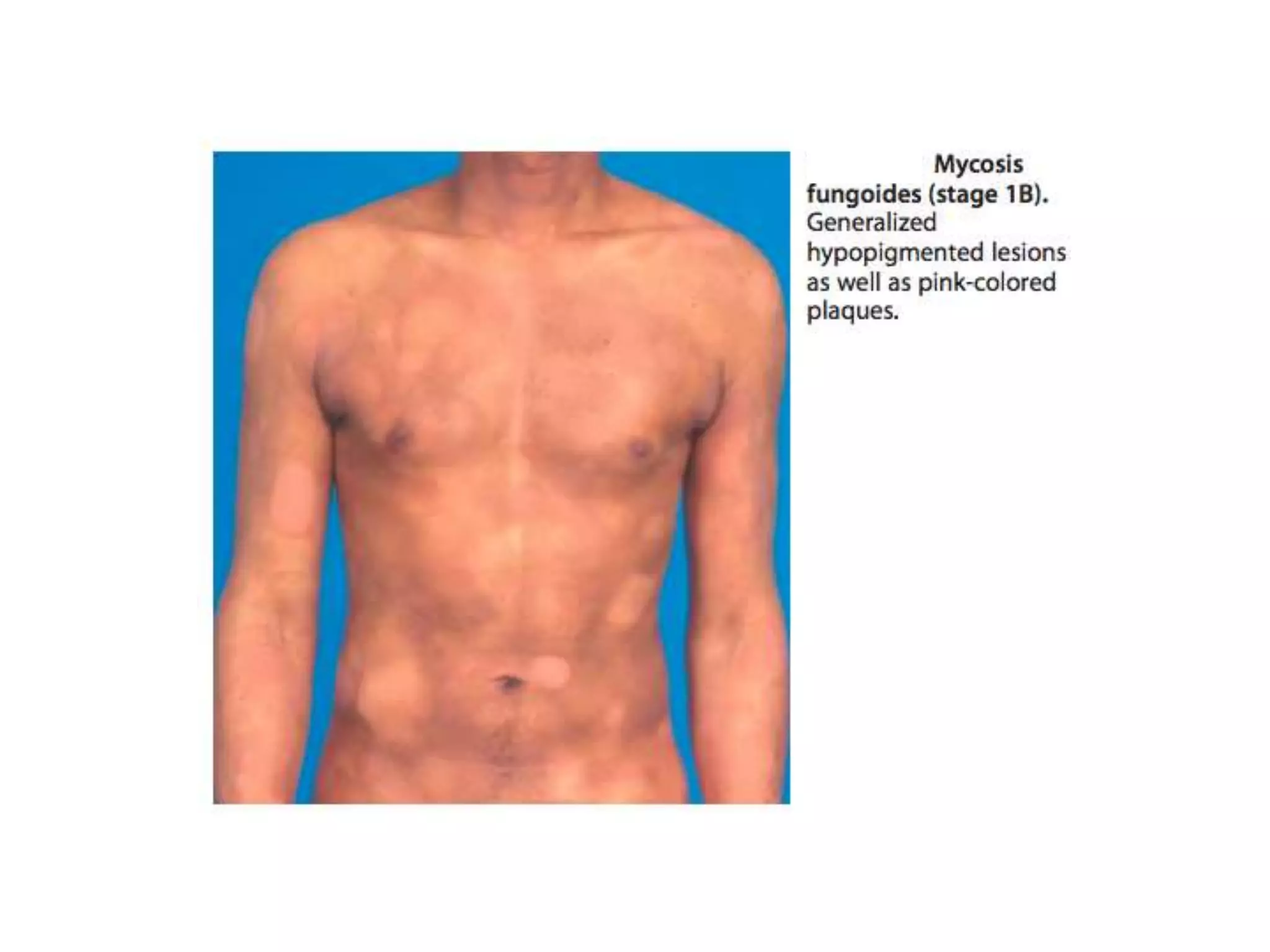 Cutaneous T Cell Lymphomas | PPTX