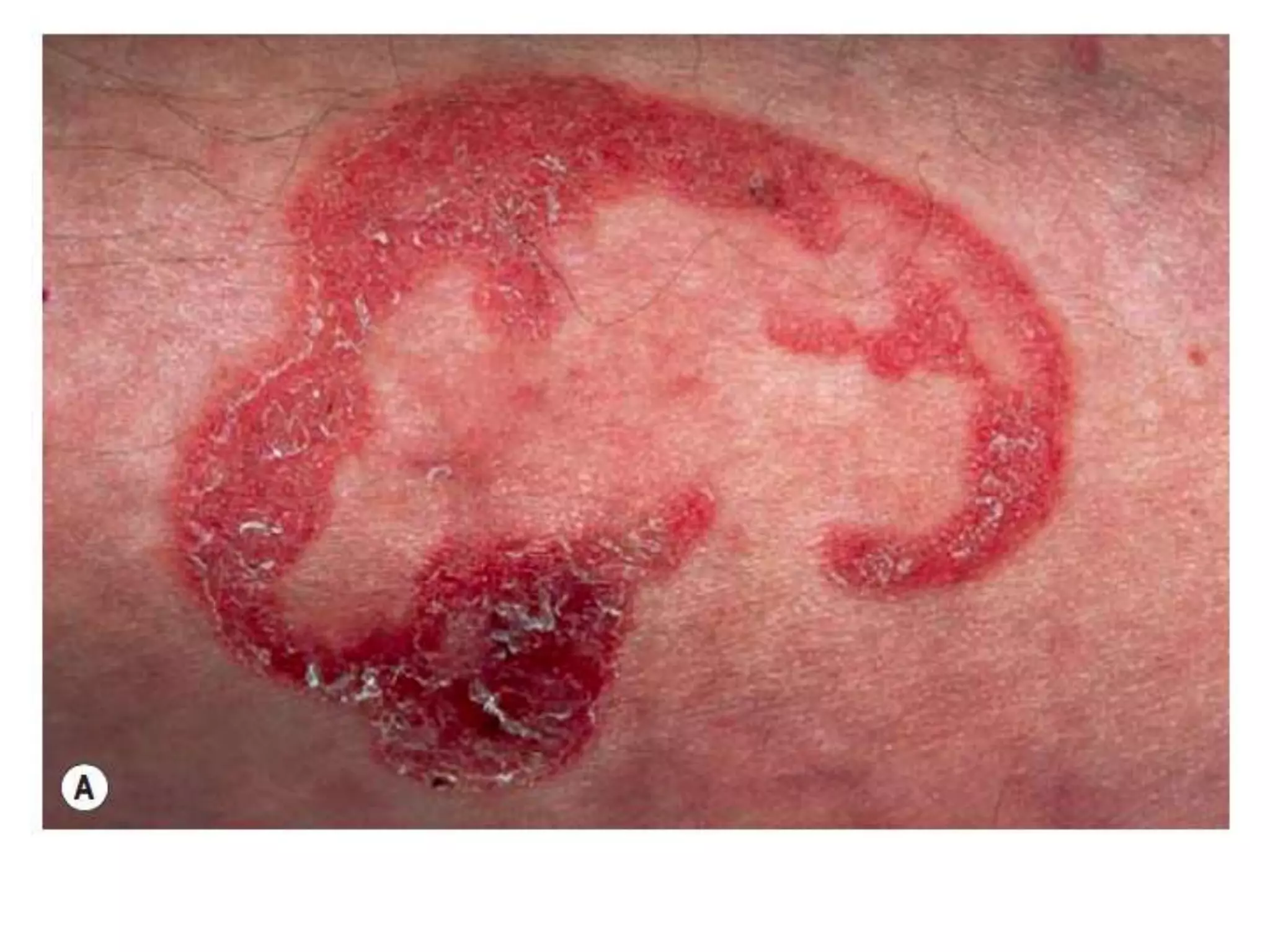 Cutaneous T Cell Lymphomas | PPTX