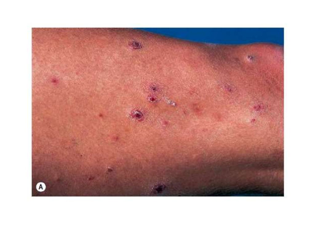 Cutaneous T Cell Lymphomas