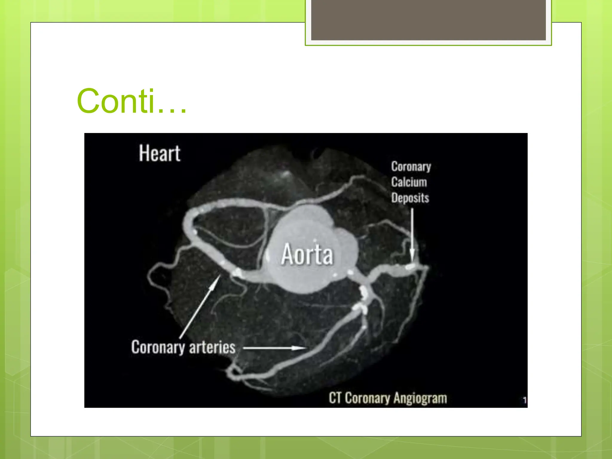 CT Coronary Angiography.pptx, eart muscle) Acute angina (type of chest ...