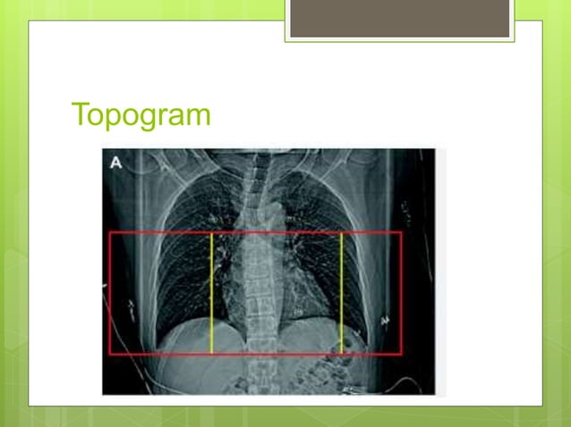 CT Coronary Angiography.pptx, eart muscle) Acute angina (type of chest ...