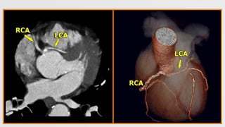 CT CORONARY ANGIOGRAPHY .pptx