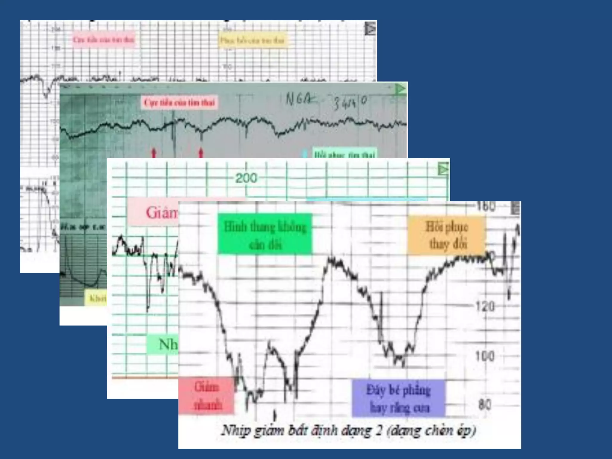 CTG ( EFM ), STRESS TEST & NON STRESS TEST | PDF