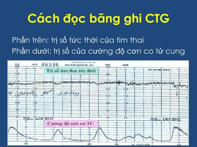 CTG ( EFM ), STRESS TEST & NON STRESS TEST | PDF