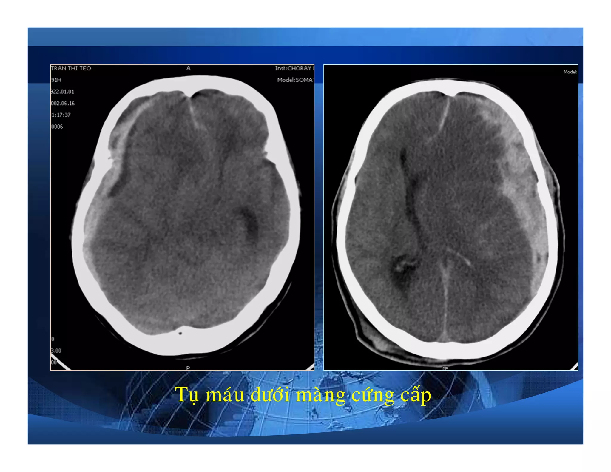 HÌNH ẢNH CT TRONG CHẤN THƯƠNG SỌ NÃO | PDF