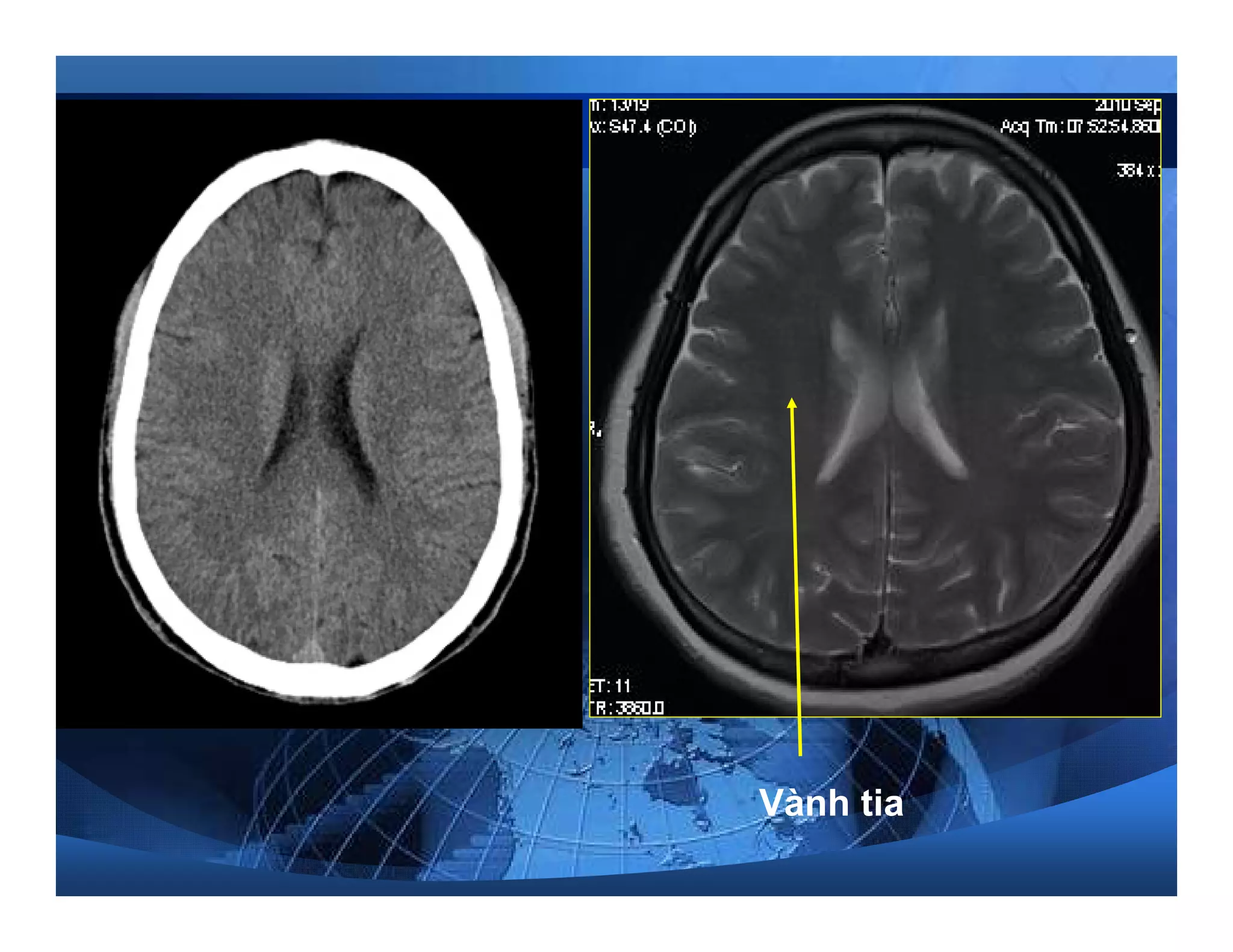 HÌNH ẢNH CT TRONG CHẤN THƯƠNG SỌ NÃO | PDF