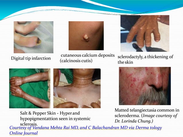 CTD-ILD.pptx | Skin and Dermatology | Diseases and Conditions