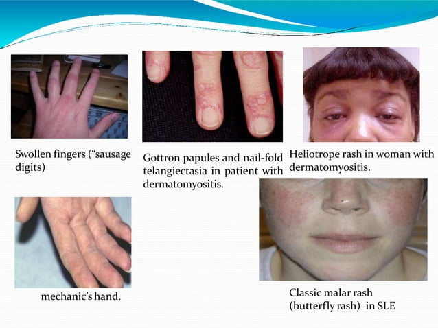 CTD-ILD.pptx | Skin and Dermatology | Diseases and Conditions