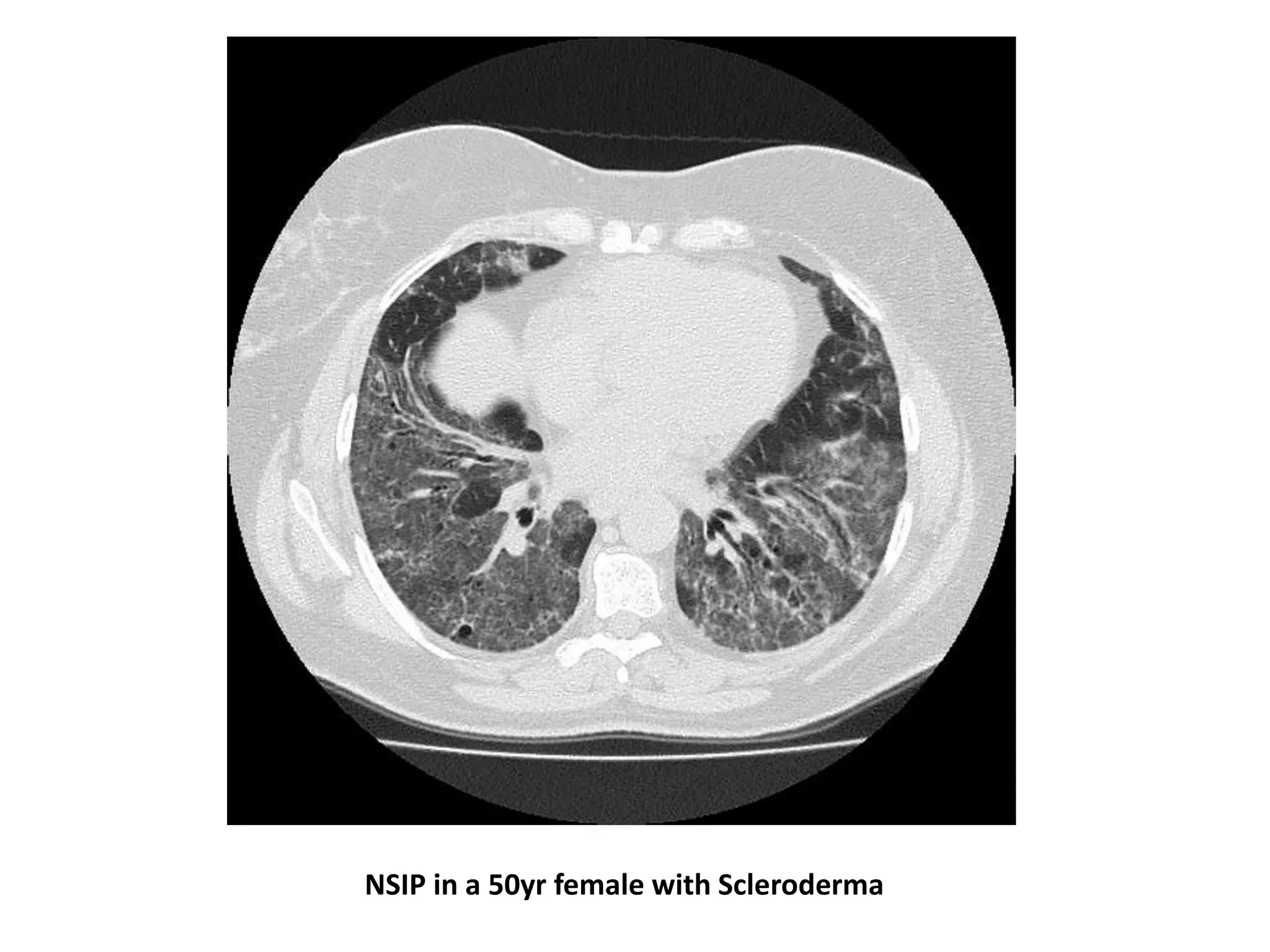 Connective tissue Disease associated Interstitial Lung Disease | PPTX
